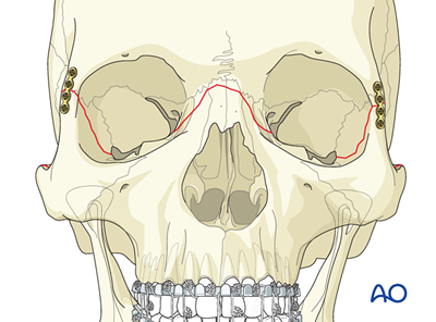 Open reduction internal fixation for Le Fort III fracture