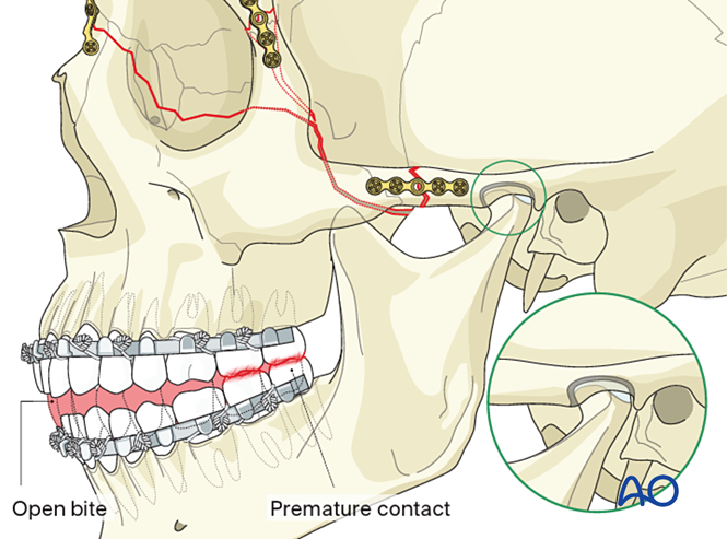 Open reduction internal fixation for Le Fort III fracture