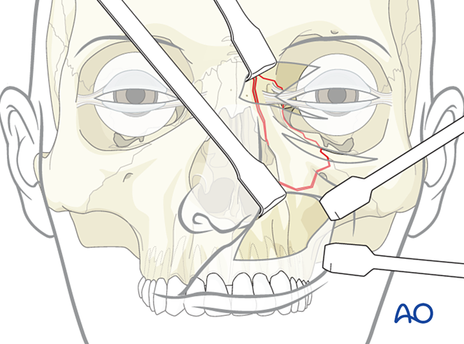 Open reduction internal fixation for NOE Type I fracture