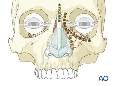 Open reduction internal fixation for NOE Type II fracture