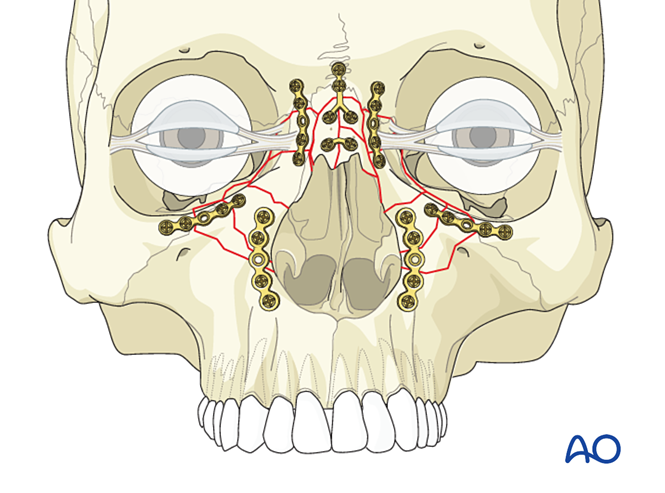 Open reduction internal fixation for NOE Type II fracture