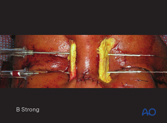 Open reduction internal fixation for NOE Type II fracture
