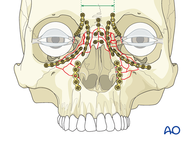 Open reduction internal fixation for NOE Type III fracture