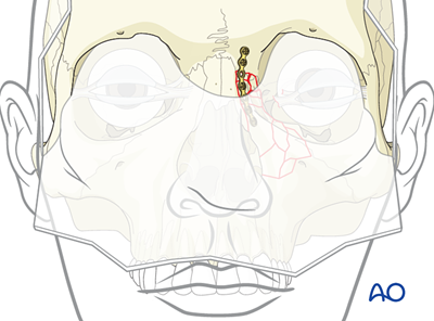 Open reduction internal fixation for NOE Type III fracture