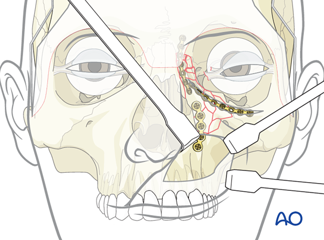 Open reduction internal fixation for NOE Type III fracture