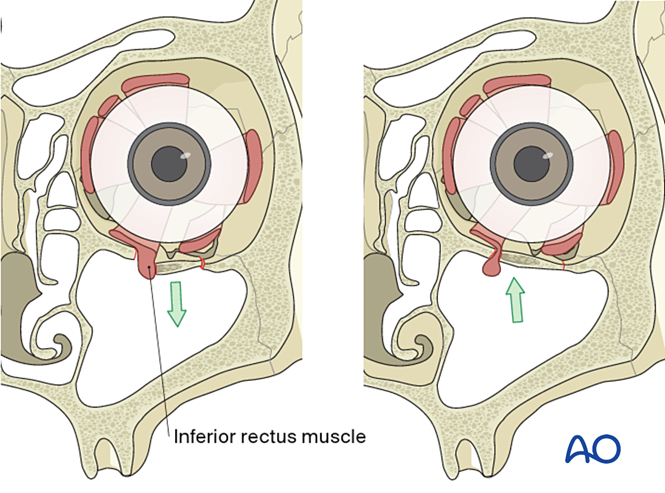 Open reduction with or without internal fixation for Orbital floor fracture