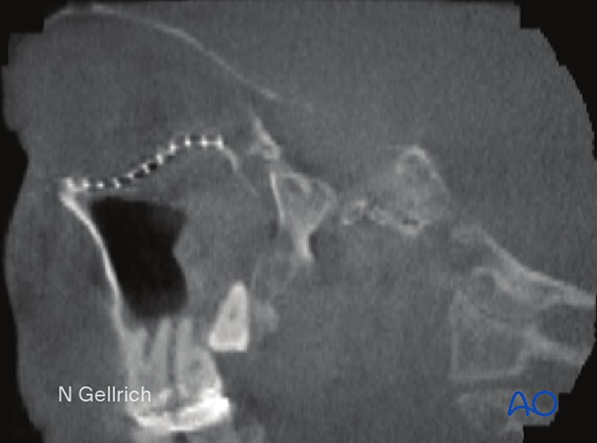Orbital reconstruction for Orbital floor fracture