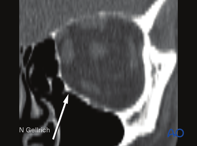 Orbital reconstruction for Orbital floor fracture