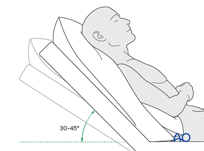 ORIF 3-point fixation (with orbital reconstruction) for Zygoma ...