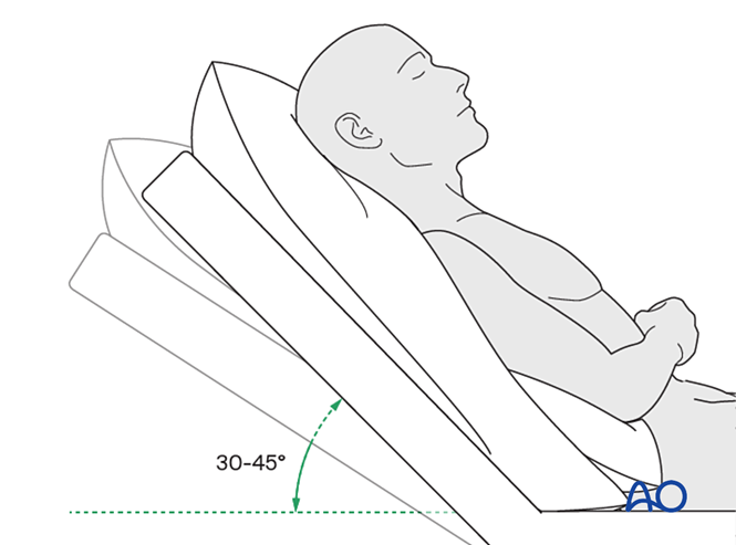 ORIF 4-point fixation (with orbital reconstruction) for Zygoma ...