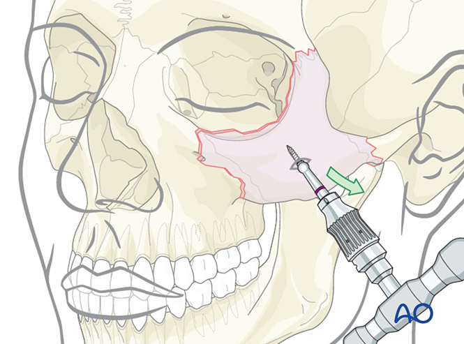 Minimally-invasive (semi-closed) treatment for Zygoma, zygomatic ...