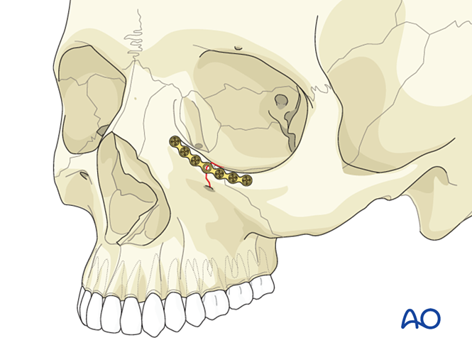 ORIF 1-point fixation (without orbital reconstruction) for Zygoma ...