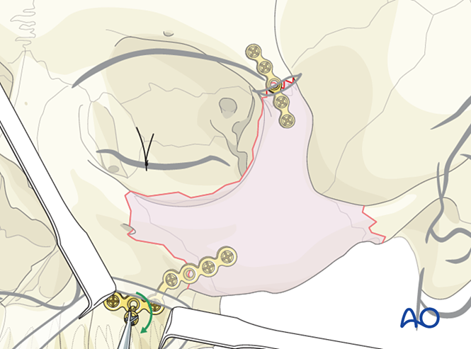 ORIF 2-point fixation (without orbital reconstruction) for Zygoma ...