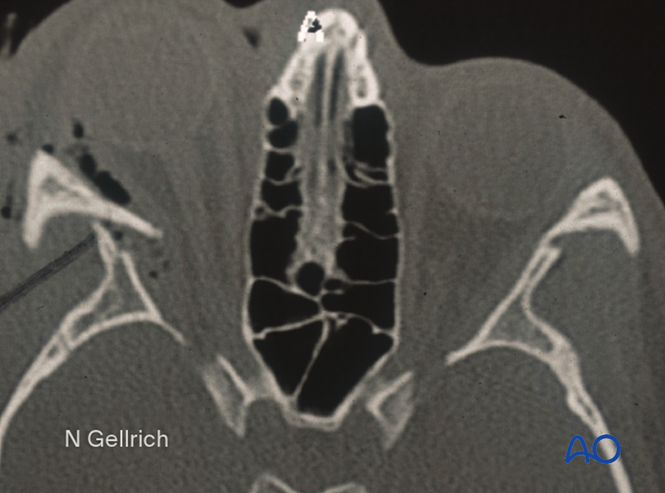 ORIF 4-point fixation (with orbital reconstruction) for Zygoma ...