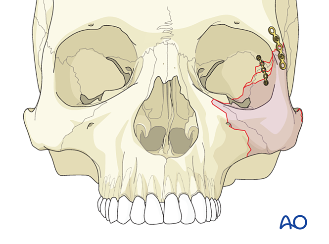 ORIF 4-point fixation (with orbital reconstruction) for Zygoma ...