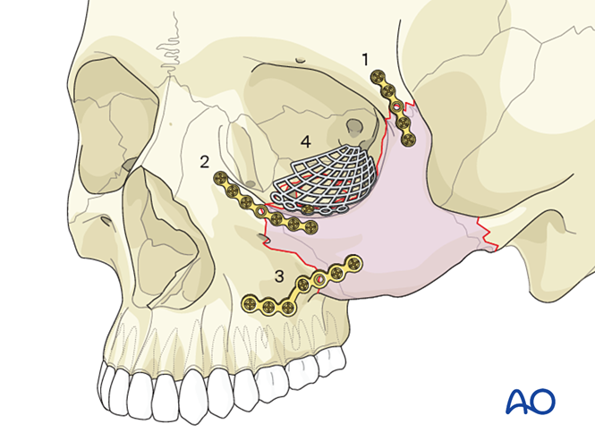 ORIF 3-point fixation (with orbital reconstruction) for Zygoma ...