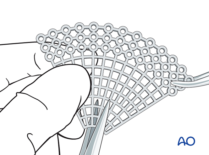 ORIF 3-point fixation (with orbital reconstruction) for Zygoma ...