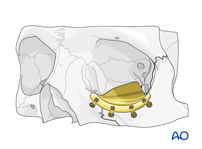 ORIF 3-point fixation (with orbital reconstruction) for Zygoma ...