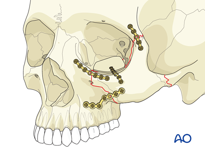 ORIF 3-point fixation (with orbital reconstruction) for Zygoma ...