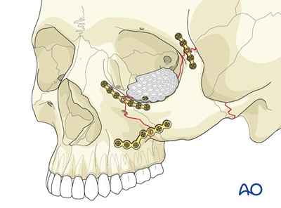 ORIF 3-point fixation (with orbital reconstruction) for Zygoma ...
