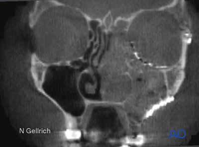 ORIF 4-point fixation (with orbital reconstruction) for Zygoma ...