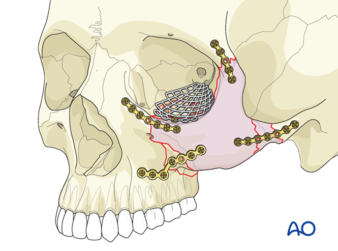 ORIF 4-point fixation (with orbital reconstruction) for Zygoma ...