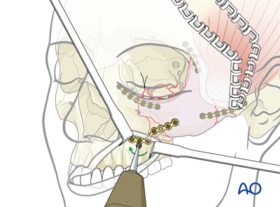 ORIF 4-point fixation (with orbital reconstruction) for Zygoma ...