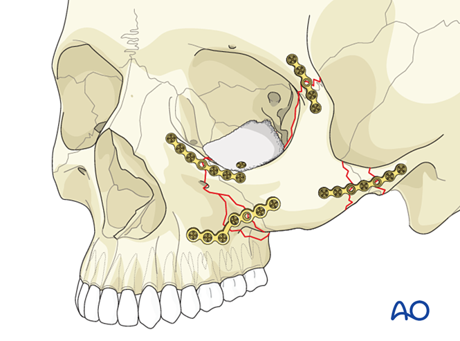 ORIF 4-point fixation (with orbital reconstruction) for Zygoma ...
