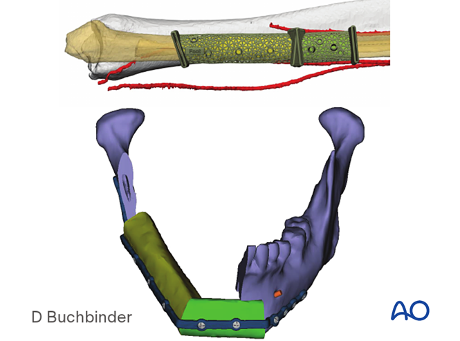 An introduction to computer assisted surgery