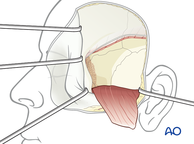 All approaches for the management of midface injuries