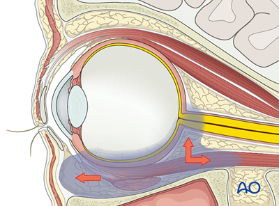 Retrobulbar hemorrhage