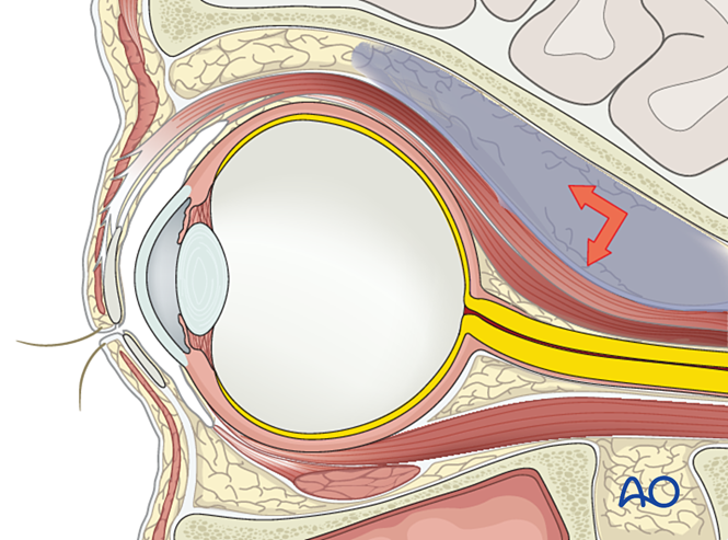 Retrobulbar hemorrhage
