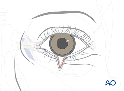 Repair of periorbital soft-tissue injuries and lacrimal system in NOE ...