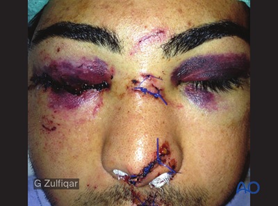 Examination of patients with midfacial injuries