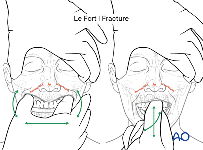 Examination of patients with midfacial injuries