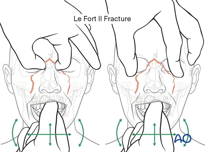 Examination of patients with midfacial injuries