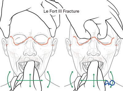 Examination of patients with midfacial injuries