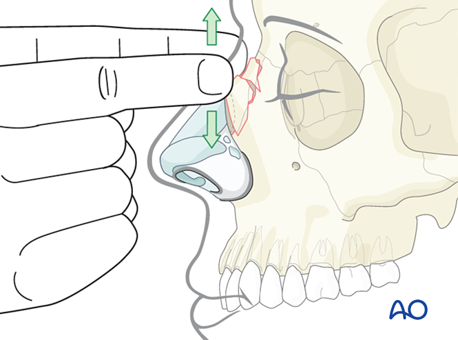 Examination of patients with nasal bone fractures