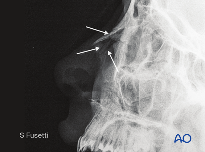 Examination of patients with nasal bone fractures