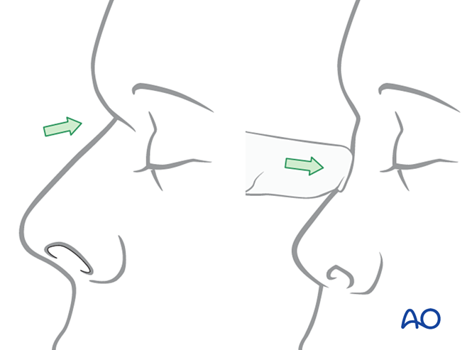 Examination of patients with NOE fractures