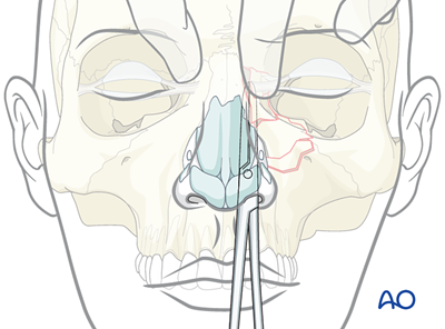 Examination of patients with NOE fractures