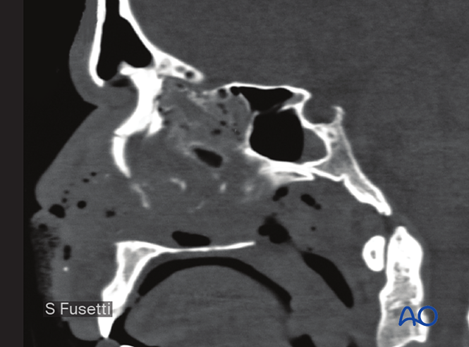 Examination of patients with NOE fractures