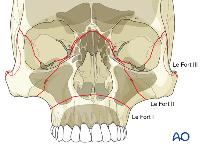 AOCMF Classification Midface (Level 1 and 2)
