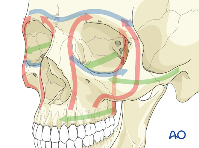 Panfacial fractures (sequencing of repair)