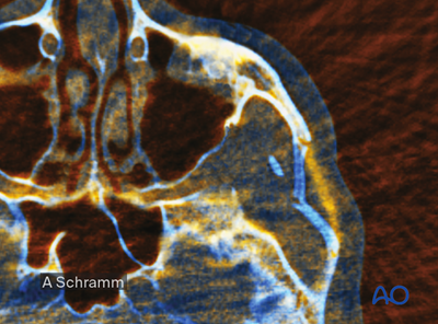 CAS: intraoperative imaging in closed treatment
