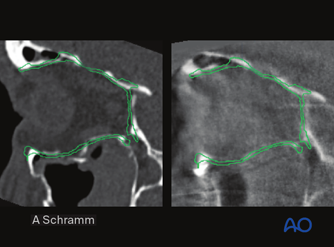 CAS: virtual planning and intraoperative imaging (ORIF without orbital ...
