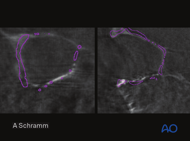 CAS: virtual planning and intraoperative imaging (ORIF with orbital ...