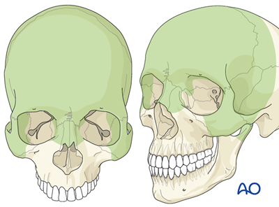 Coronal approach (including craniotomy)