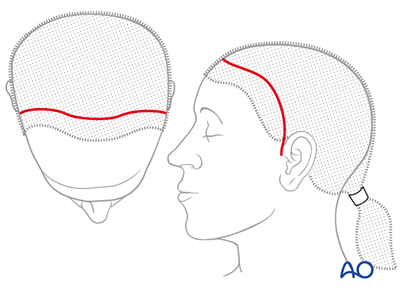 Coronal approach (including craniotomy)