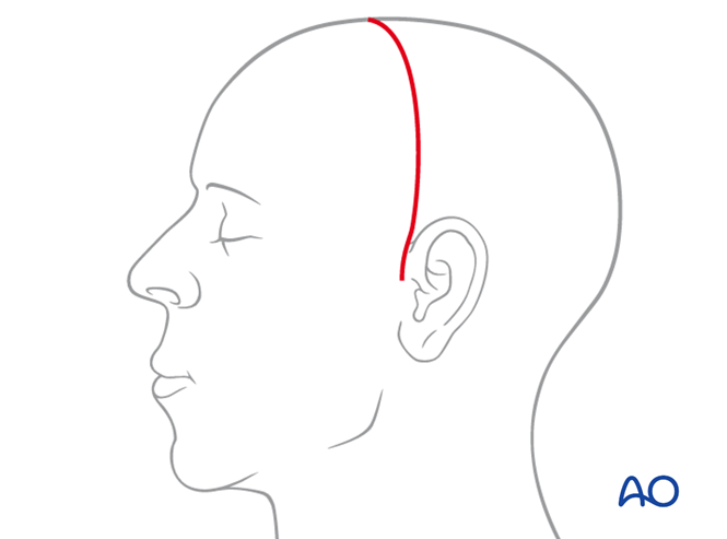 Coronal approach (including craniotomy)